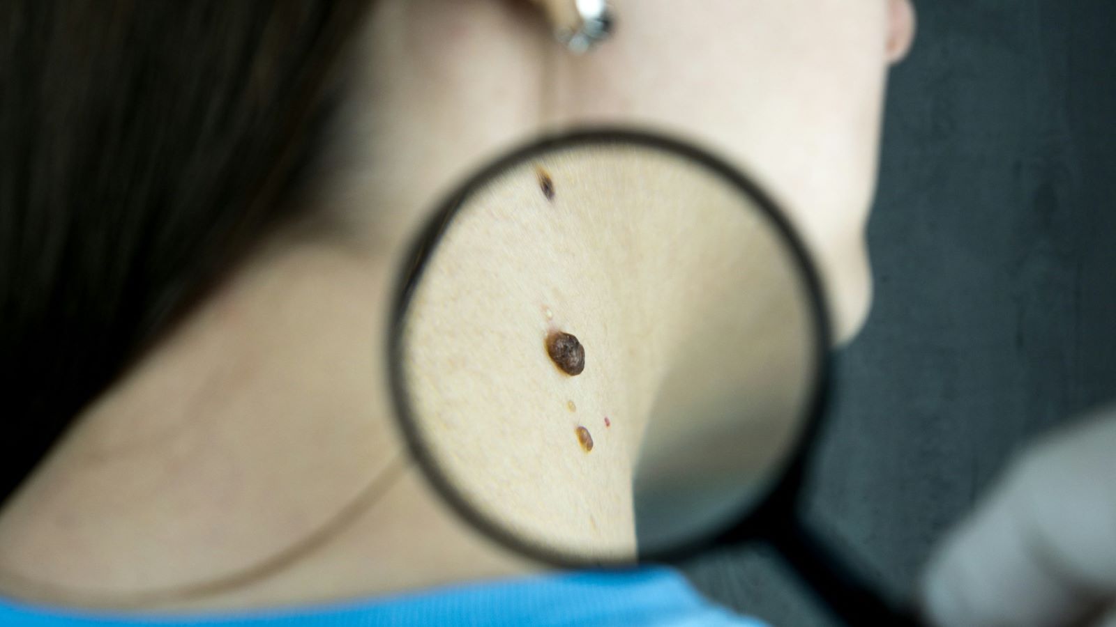 Prevence rakoviny kůže: Nechte si zdarma zkontrolovat znaménka